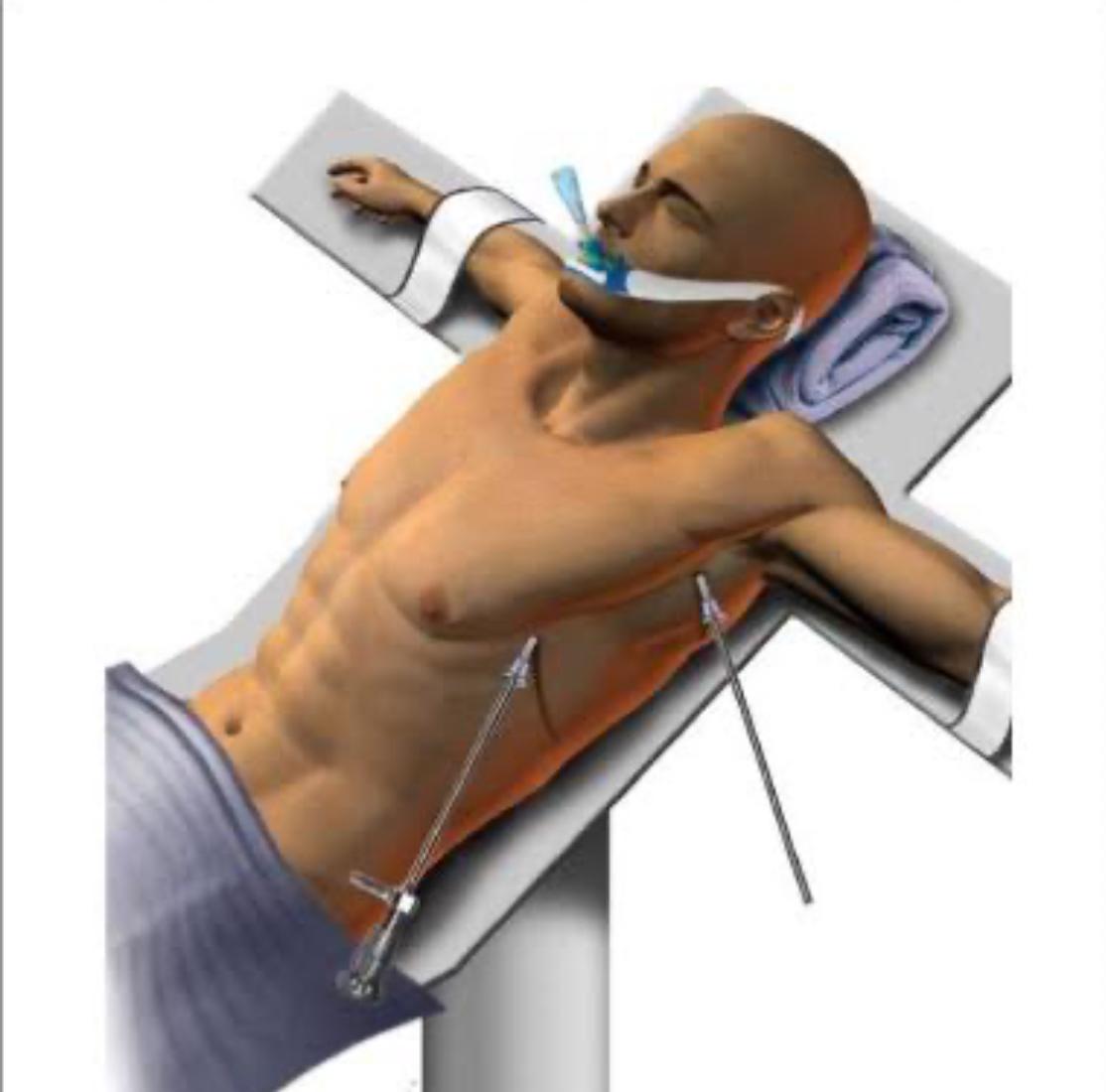 Procedimentos minimamente invasivos para Simpatectomia - Dr. Gustavo ...